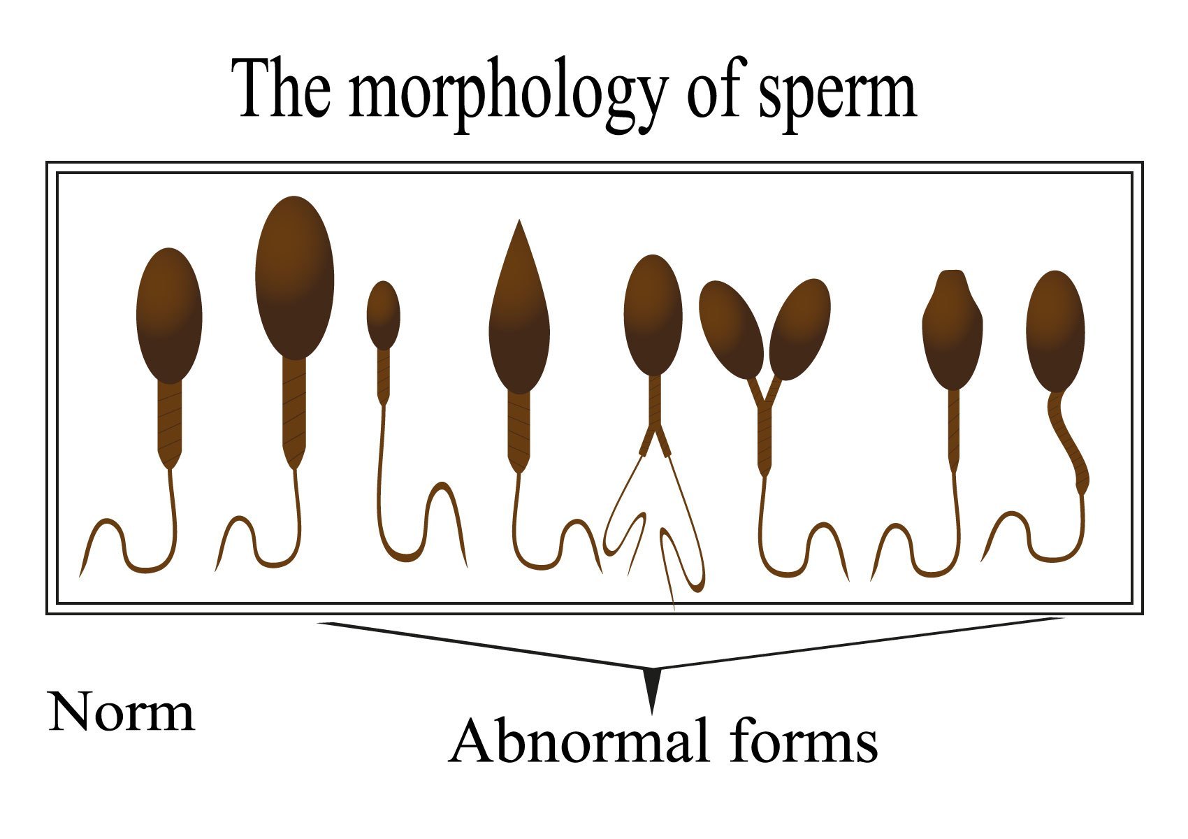 Understanding High Sperm Abnormality And Abnormalities Of Sperm In Men